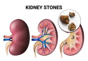 8 Easy Ways to Cleanse Your Kidneys