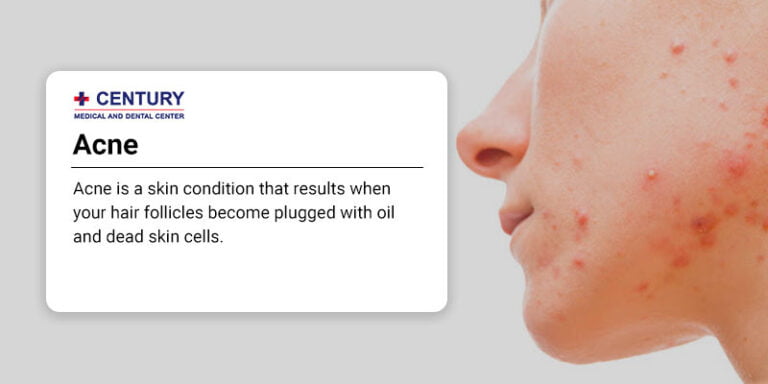 What's the Difference Between Acne and Sebaceous Cysts? - Century ...