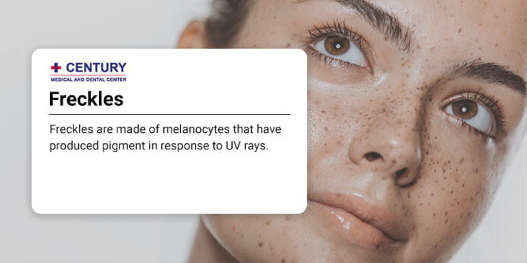 How to Tell the Difference Between a Mole and a Freckle - Century ...