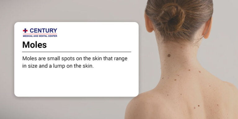 How to Tell the Difference Between a Mole and a Freckle - Century ...