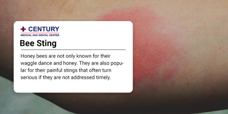 Home Remedies to Help Treat a Bee Sting Reaction