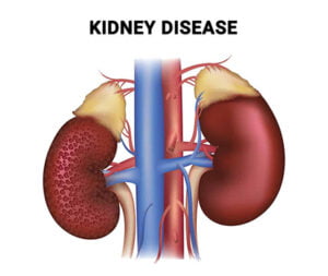 How Long Can You Stay in Stage 3 Kidney Disease? - Century Medical ...
