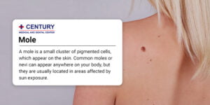 What Happens if You Accidentally Scratch off a Mole? - Century Medical ...