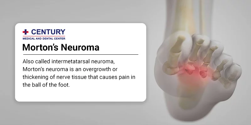 Morton Neurom Morton Neuroma, Mortons Metatarsalgie, Intermetatarsal
