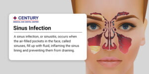Are Sinus Infections Contagious? - Century Medical & Dental Center