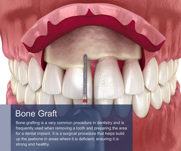 Dental Bone Graft Surgery Procedure | Bone Grafting in Manhattan ...