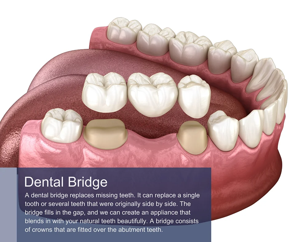 Dental Bridges For Front Teeth Dental Bridge Cost | From £695 | Mint