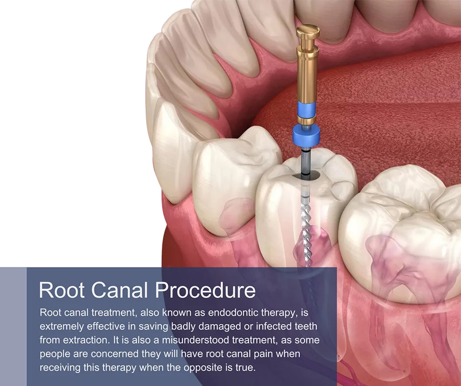 Root Canal Root Canal Molar Root Canals Endodontic Management Of The