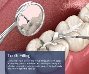 Tooth Filling NYC | Best Dental Fillings in Midtown Manhattan ...