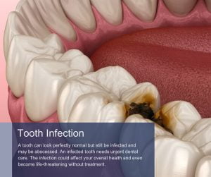 Tooth Infection Treatment Midtown Manhattan | Wisdom Tooth & Root Canal ...